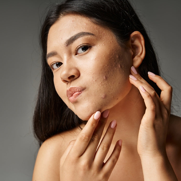 Exploring Which Acne Treatment Better for scars - Context Skin - Context Skin